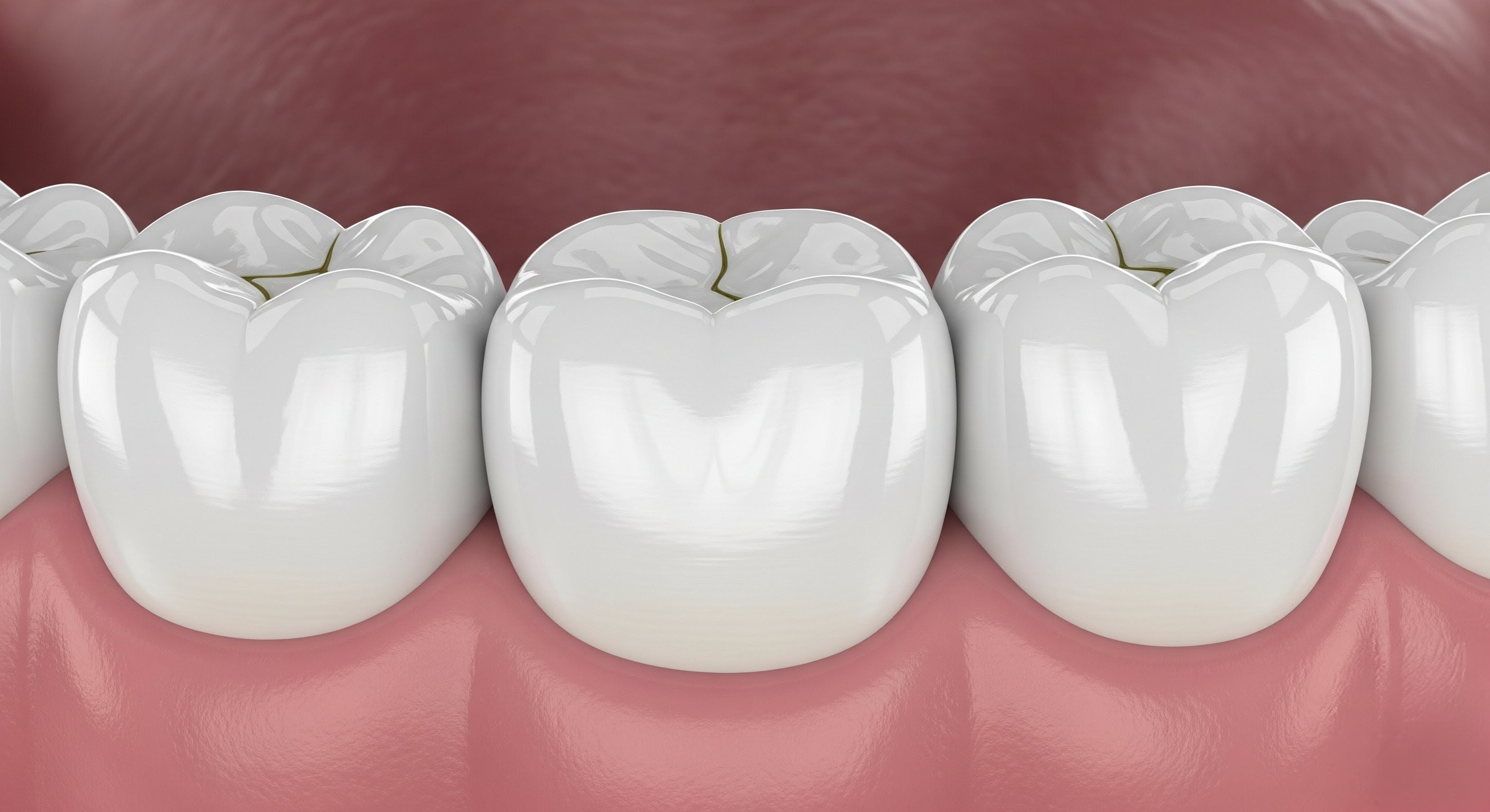 What Are Composite Fillings